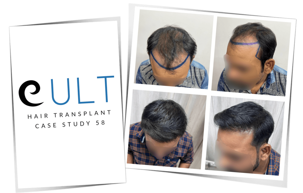 Grade 1 & Grade 2 Hair Transplant Results | Cult Aesthetics