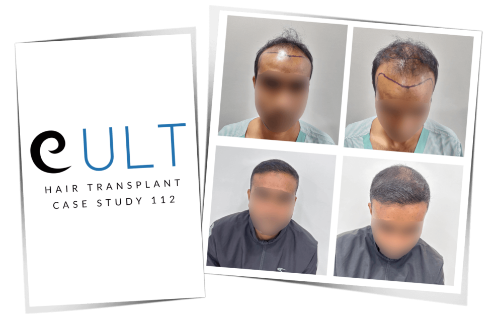 Grade 1 & Grade 2 Hair Transplant Results | Cult Aesthetics
