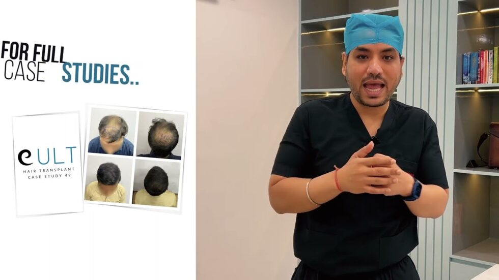 Hair Transplant in Gurgaon: Crown Baldness & Results Explained